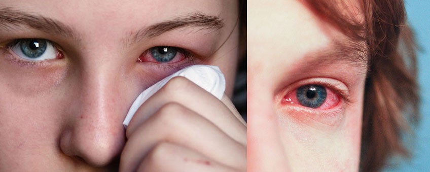 Conjuntivite Alérgica - O que é, Tipos, Causas e Tratamentos | Dicas de ...