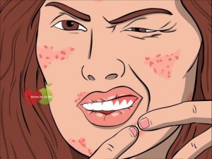 Acne Cística - O que é, Como Curá-la | Dicas de Saúde