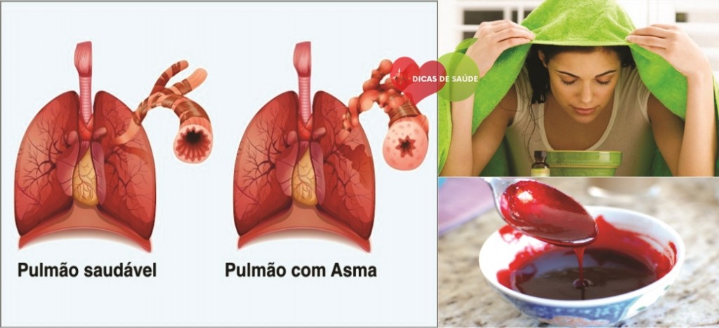 Os 35 Remédios Caseiros Para Aliviar a Asma de Forma Natural | Dicas de ...