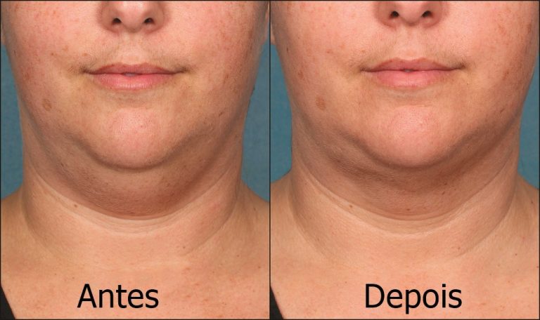 Os 4 Exercícios que Ajudarão a Eliminar a Papada | Dicas de Saúde