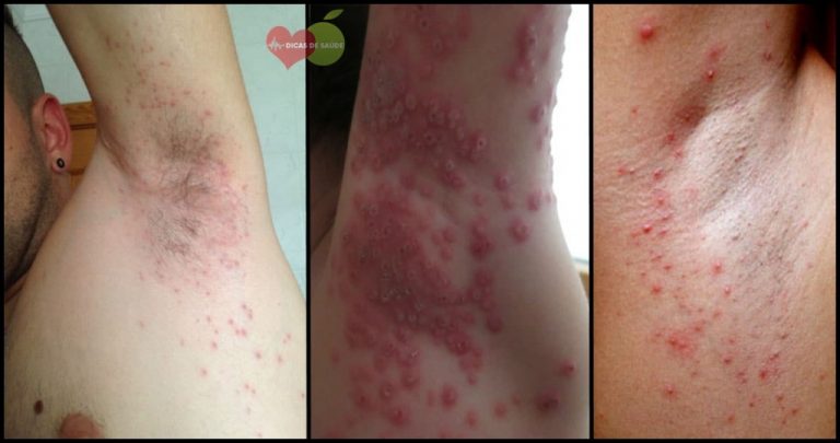 Como Eliminar os Fungos das Axilas Naturalmente | Dicas de Saúde