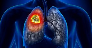 Embolia Pulmonar - O que é, Sintomas, Tratamentos | Dicas de Saúde