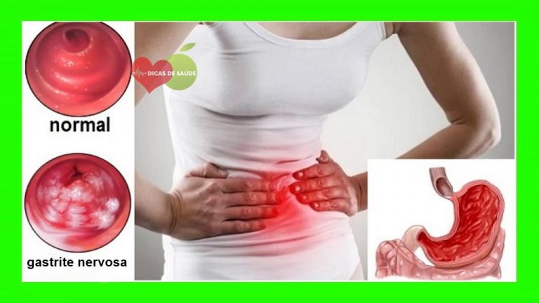 Os 10 Principais Sintomas da Gastrite Nervosa 【ATUALIZADO】