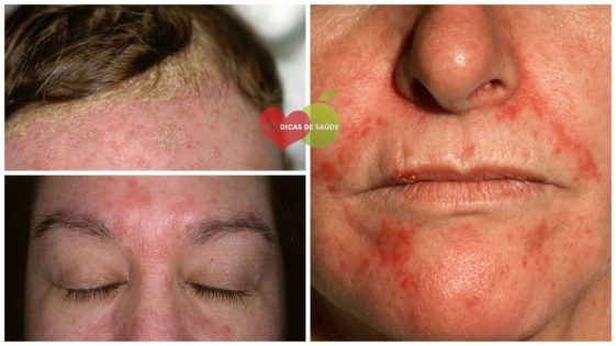 Dermatite Seborreica - O que é, Causas, Sintomas e Tratamento | Dicas ...