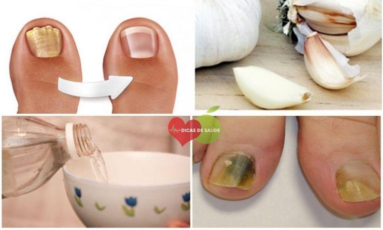 Como Eliminar os Fungos nas Unhas com 2 Ingredientes | Dicas de Saúde Como Eliminar os Fungos nas Unhas com 2 Ingredientes | Dicas de Saúde