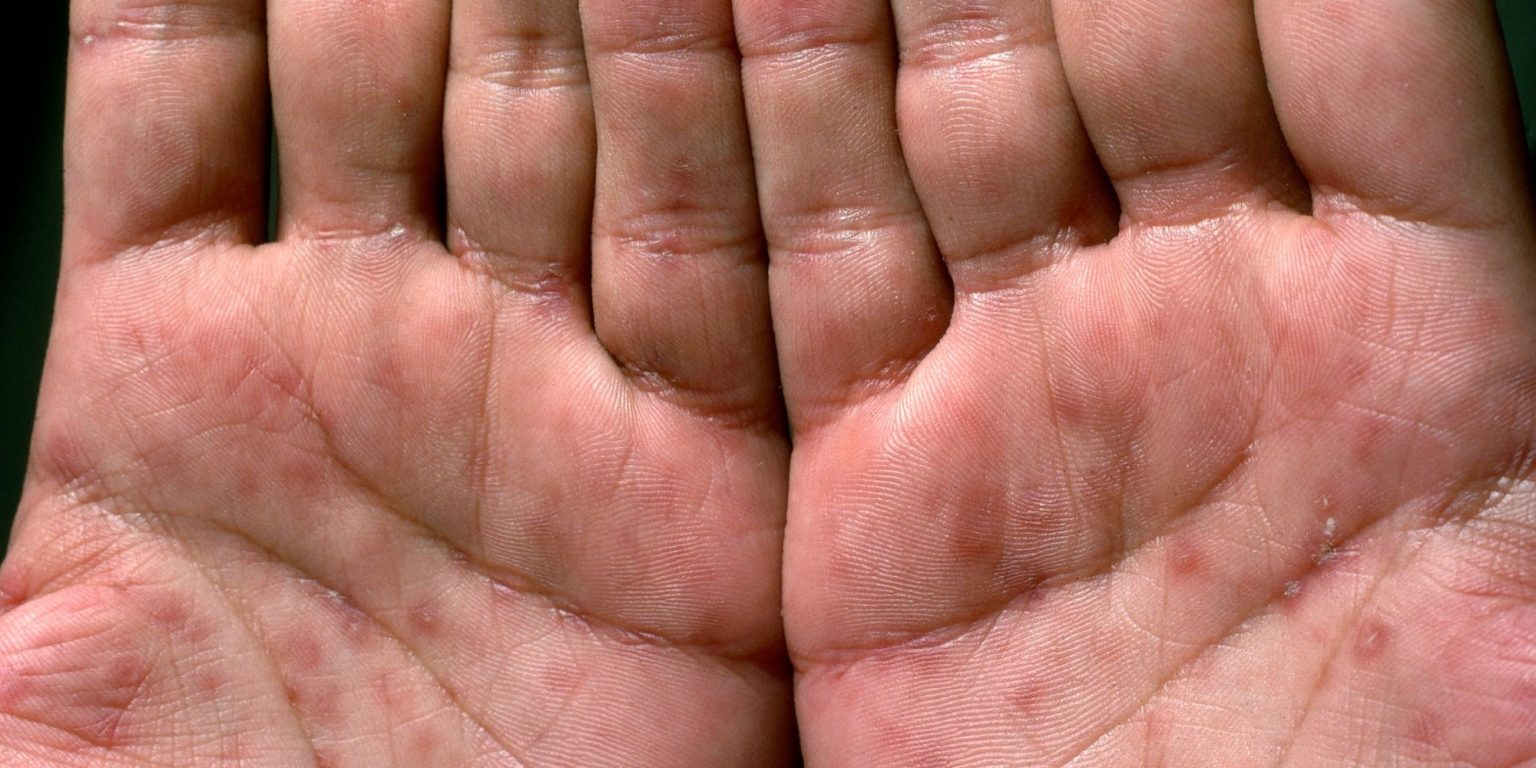 Os 5 Principais Sintomas da Sífilis que Você não Conheçe | Dicas de Saúde