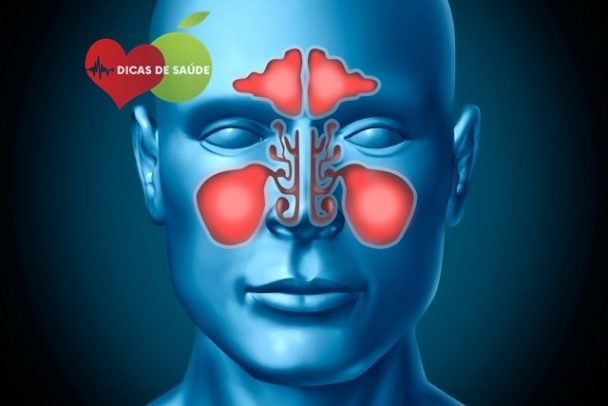 Sinusite - O que é, Causas, Sintomas e Tratamento | Dicas de Saúde