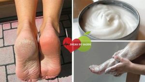 As 4 Receitas Caseiras Para Acabar com Calcanhar Rachado | Dicas de Saúde