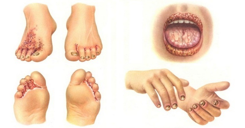 Candidíase - O que é, Sintomas, Tratamento | Dicas de Saúde