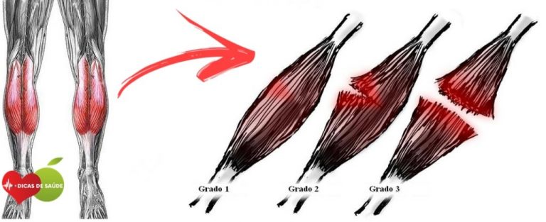 Distensão Muscular - O que é, Sintomas e Tratamento 【ATUALIZADO】