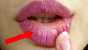 Os 7 Principais Sintomas da Queilite Angular | Dicas de Saúde