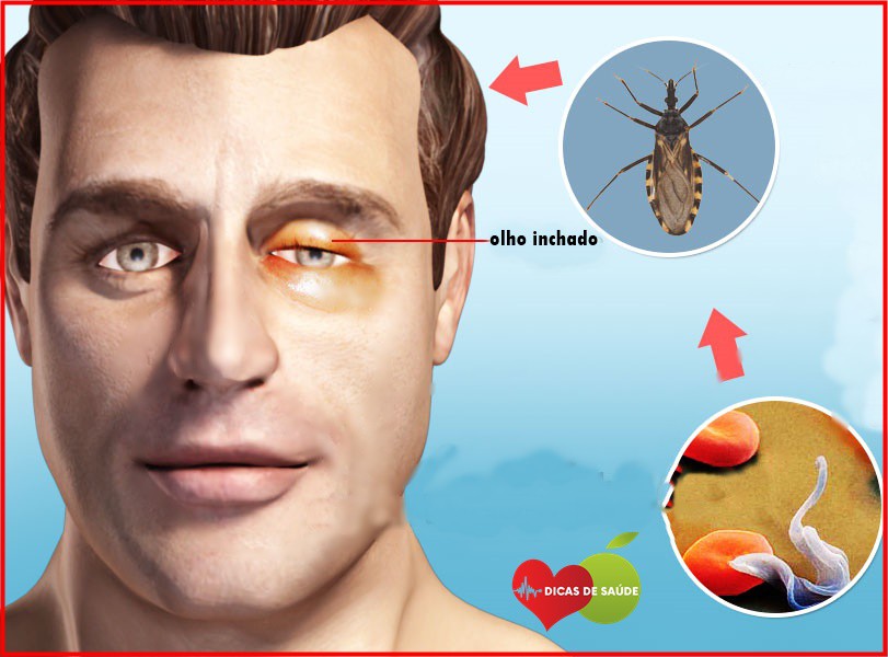 Os 16 Principais Sintomas da Doença de Chagas | Dicas de Saúde