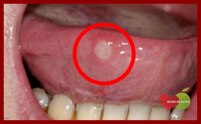 Como Curar Afta na Língua em 5 Minutos 【ATUALIZADO】