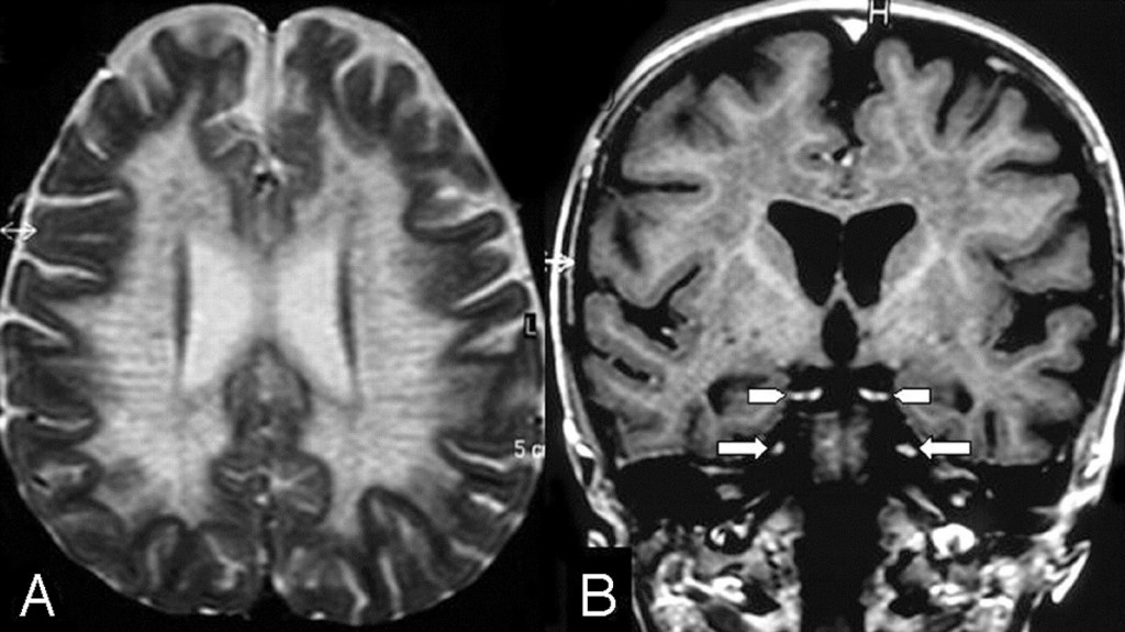 Doença de Canavan – O que é, Sintomas e Tratamentos | Dicas de Saúde