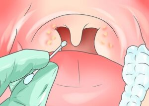 Faringite - O que é, Sintomas e Tratamento 【ATUALIZADO】