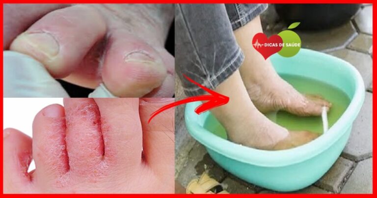 Os 12 Remédios Caseiros Para Acabar com a Frieira | Dicas de Saúde