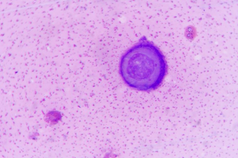 Histoplasmose - O que é, Sintomas e Tratamentos | Dicas de Saúde