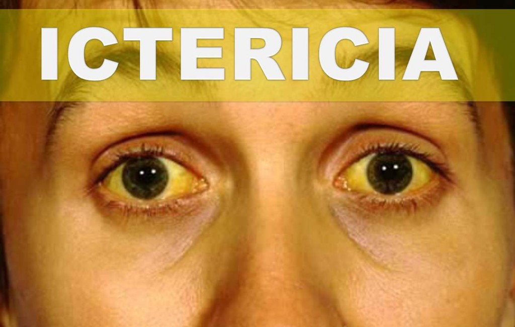 2 Remédios Caseiros Para Tratar Icterícia em Casa | Dicas de Saúde