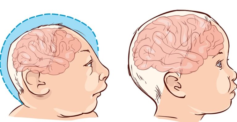 Macrocefalia - O que é, Sintomas e Tratamentos | Dicas de Saúde