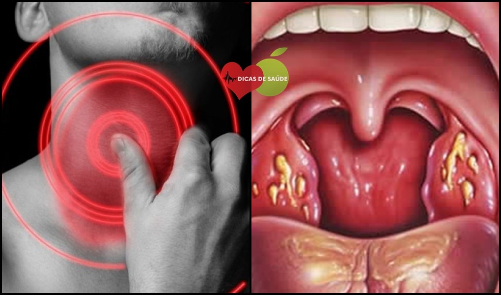 Os 5 Remédios Caseiros Para Aliviar Garganta Inflamada 【atualizado】