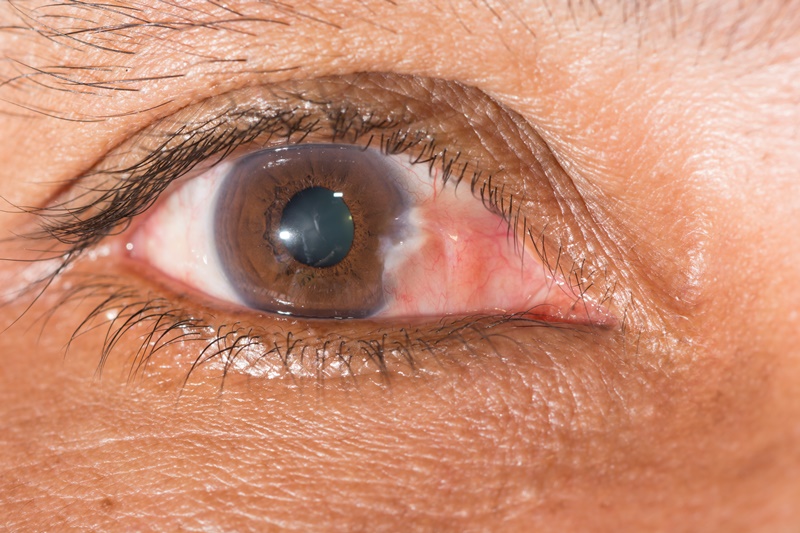 Pterígio - O que é, Sintomas e Tratamentos 【ATUALIZADO】