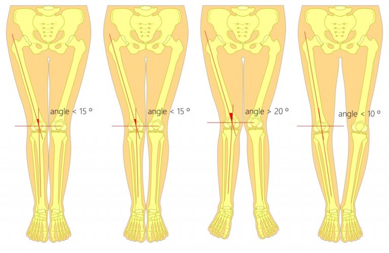 Os 10 Principais Sintomas do Raquitismo 【ATUALIZADO】