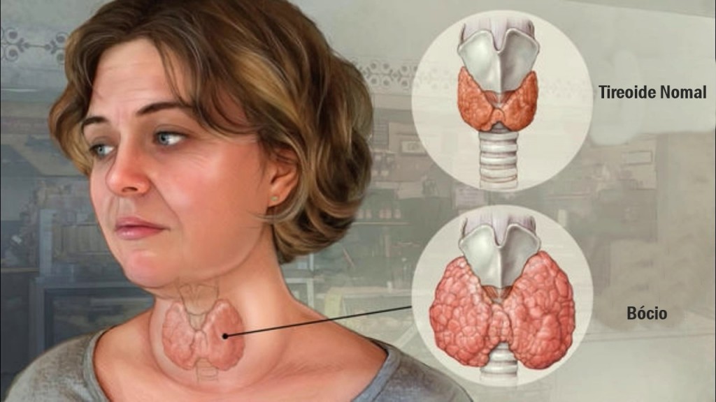Os 10 Remédios Caseiros Para Tratar Bócio 【ATUALIZADO】