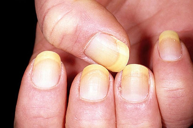 Síndrome das Unhas Amarelas - O que é, Sintomas e Tratamentos | Dicas ...
