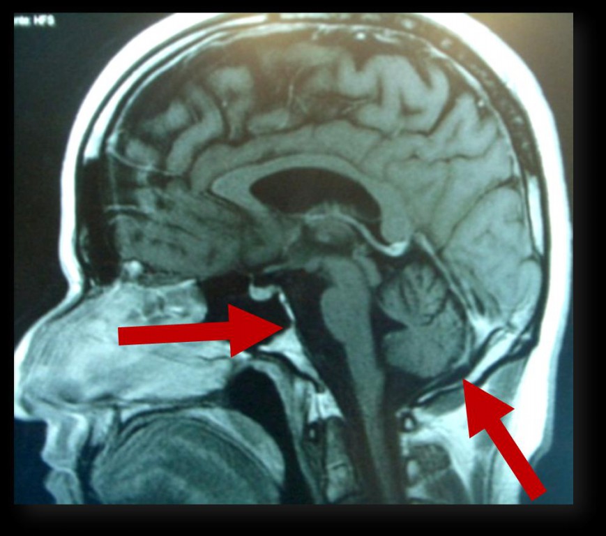 Síndrome de Wallenberg – O que é, Sintomas e Tratamentos