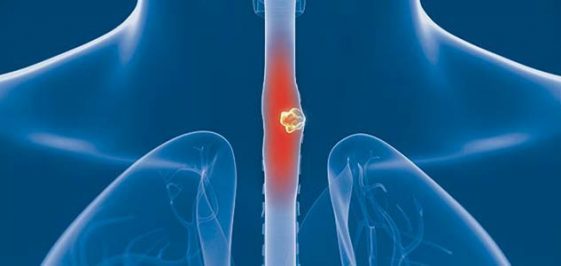 Câncer de Esôfago - O que é, Sintomas e Tratamentos | Dicas de Saúde