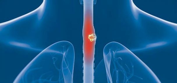 Câncer de Esôfago - O que é, Sintomas e Tratamentos | Dicas de Saúde