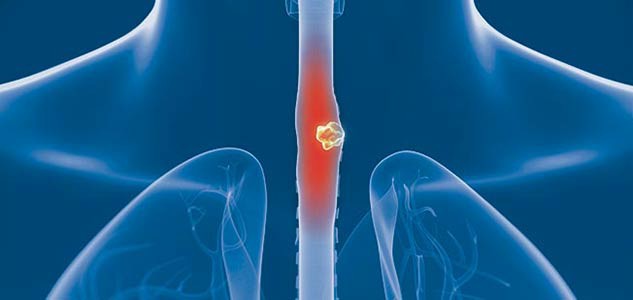 Câncer de Esôfago - O que é, Sintomas e Tratamentos | Dicas de Saúde