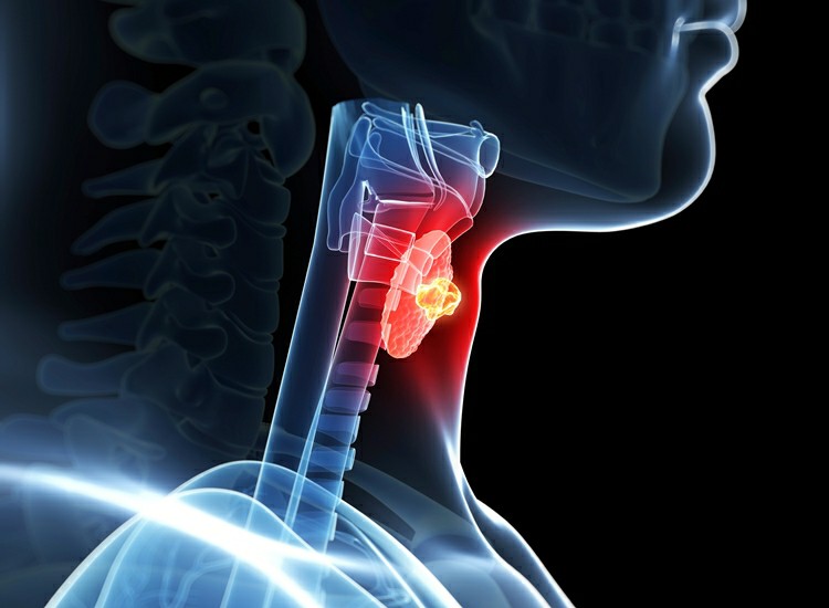 Câncer de Garganta - O que é, Sintomas e Tratamentos 【Atualizado】