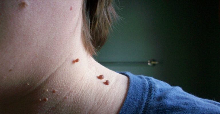 Fibroma - Causas, Sintomas e Tratamentos | Dicas de Saúde