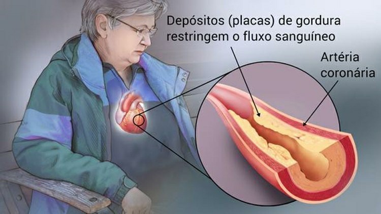 Isquemia Miocárdica - O que é, Sintomas e Tratamentos | Dicas de Saúde