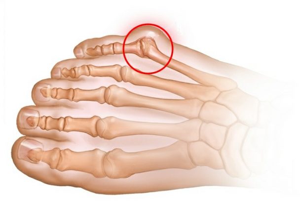 Joanete - O que é, Causas, Sintomas e Tratamentos | Dicas de Saúde