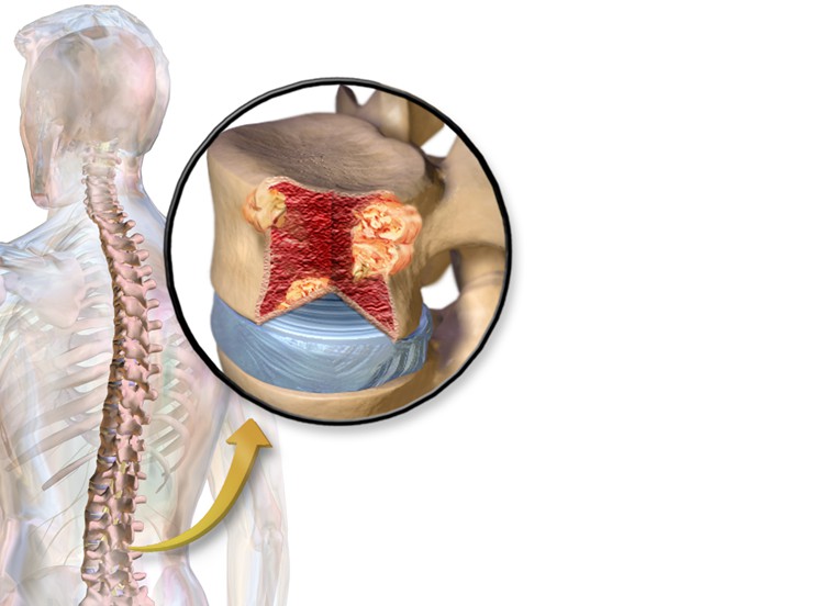Mieloma Múltiplo - O que é, Sintomas e Tratamentos | Dicas de Saúde
