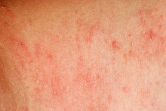Dermatofitose - O que é, Causas, Sintomas e Tratamentos | Dicas de Saúde