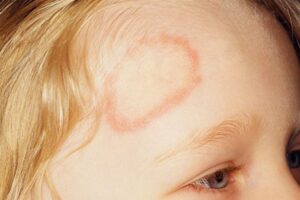 Dermatofitose - O que é, Causas, Sintomas e Tratamentos | Dicas de Saúde