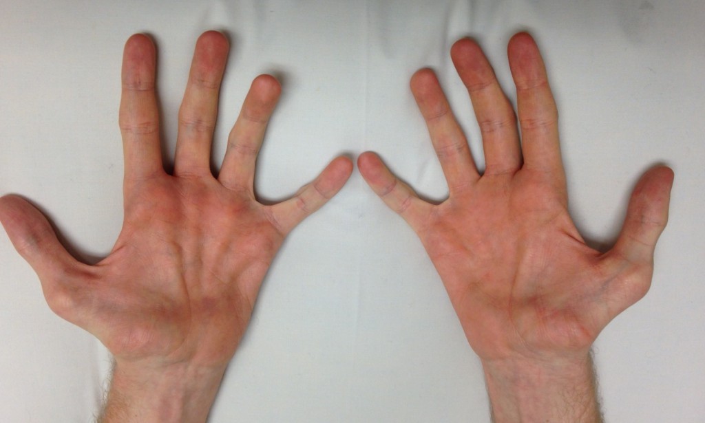 Doença de Refsum - O que é, Sintomas e Tratamentos 【ATUALIZADO】