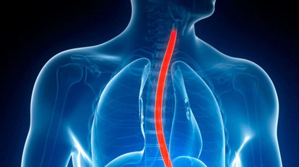 Esófago de Barret - Causas, Fatores de Risco e Tratamentos | Dicas de Saúde