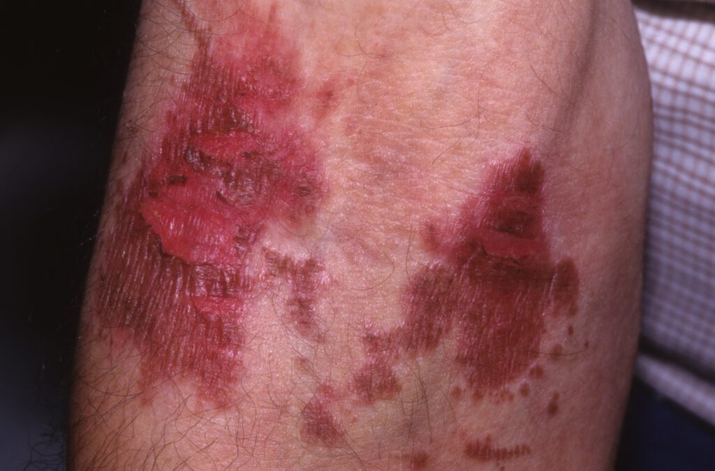 Glucagonoma – O que é, Causas, Sintomas e Tratamentos | Dicas de Saúde