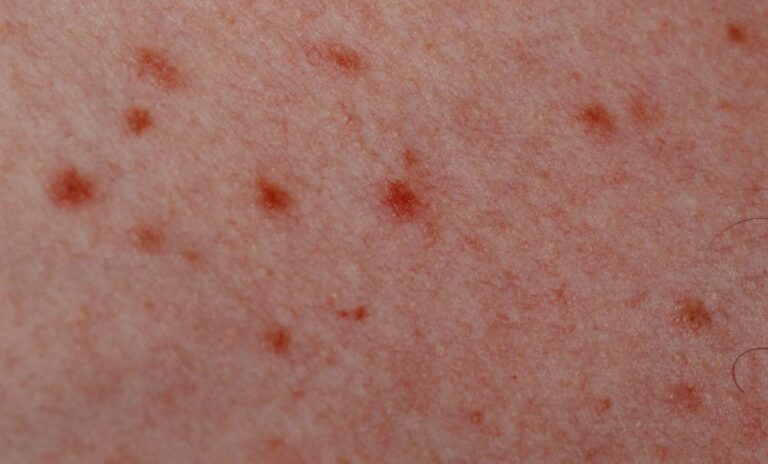 Mastocitose - O que é, Causas, Sintomas e Tratamentos | Dicas de Saúde