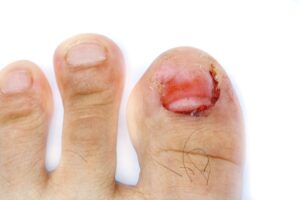 Panarício - O que é, Sintomas e Tratamentos | Dicas de Saúde