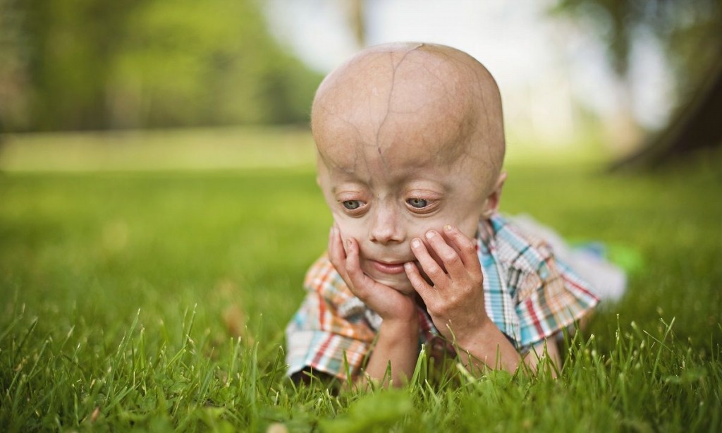 Os 5 Principais Sintomas da Progéria | Dicas de Saúde