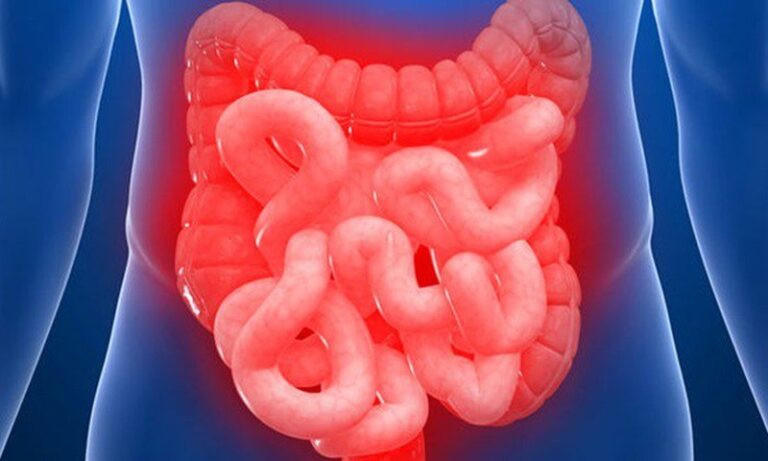 Síndrome do Intestino Irritável - Causas, Sintomas e Tratamentos ... Síndrome do Intestino Irritável - Causas, Sintomas e Tratamentos ...