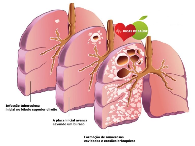 Os 8 Principais Sintomas da Tuberculose | Dicas de Saúde