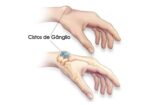 Cistos de Gânglio - O que é, Causas, Sintomas e Tratamentos | Dicas de ...