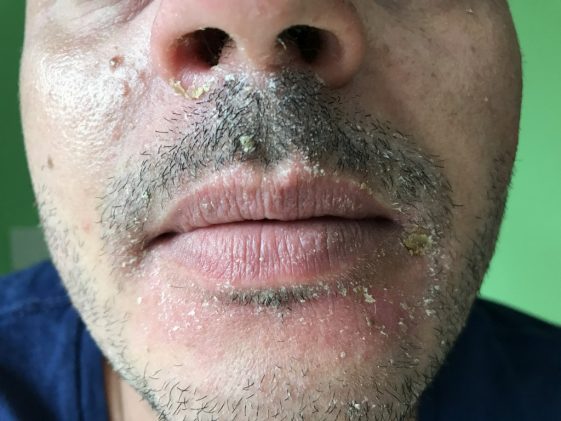Dermatite Seborreica - O que é, Sintomas e Tratamentos | Dicas de Saúde
