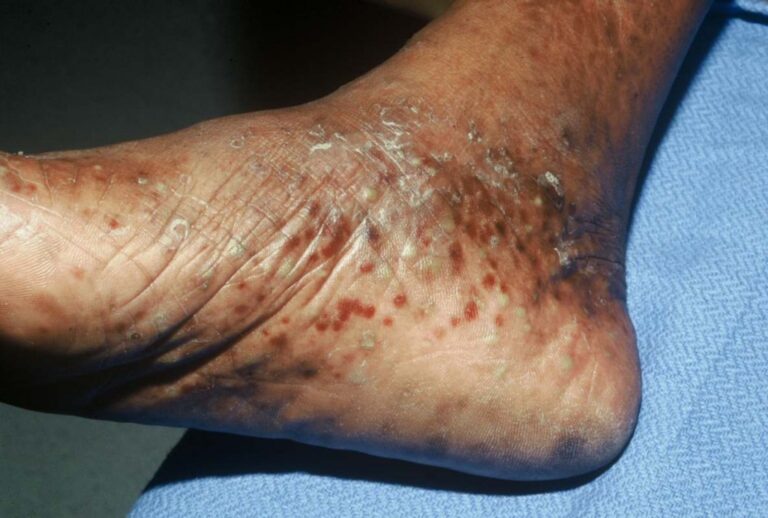 Eczema Disidr tico O Que Sintomas E Tratamentos Dicas De Sa de eczema-disidr-tico-o-que-sintomas-e-tratamentos-dicas-de-sa-de